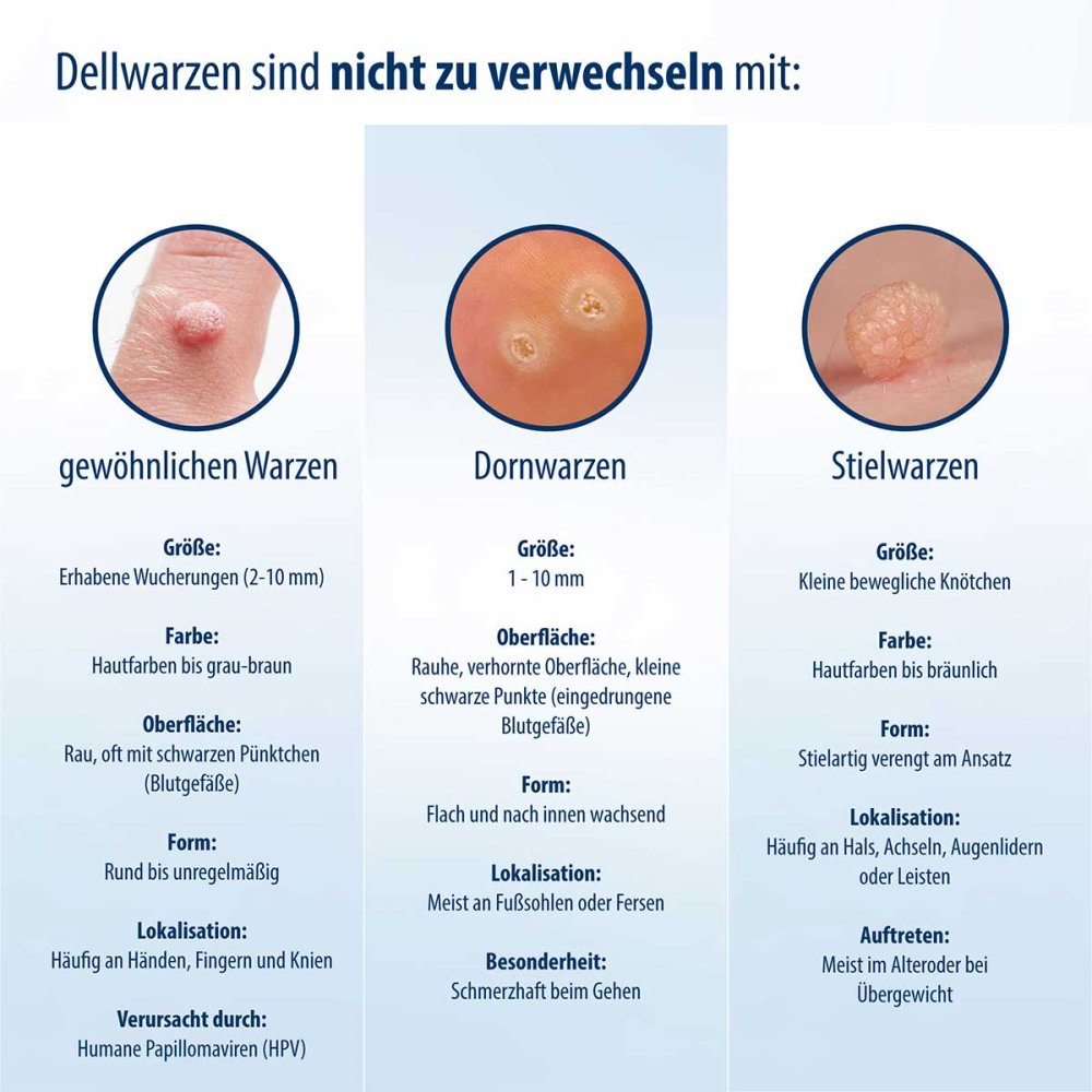Evolsin Dellwarzen Mittel Lösung 5 ml online kaufen